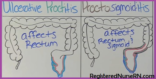 Ulcerative Colitis NCLEX Review