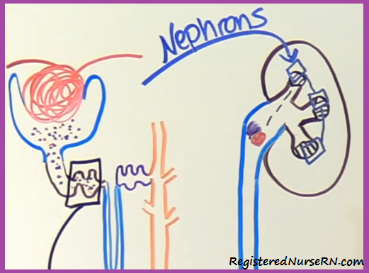 Renal Calculi (Kidney Stones) NCLEX Review