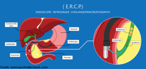 Cholecystitis NCLEX Nursing Review