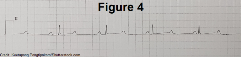 EKG Rhythm Practice Quiz for AV Heart Blocks | 1st Degree, 2nd Degree ...
