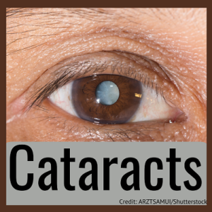 Cataracts NCLEX Nursing Questions Quiz | Eye Disorders NCLEX