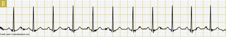 Sinus Tachycardia ECG/EKG Rhythm Quiz