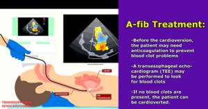 Atrial Fibrillation (a-fib) ECG/EKG Nursing Review