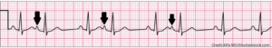 Premature Atrial Contractions Nursing Review